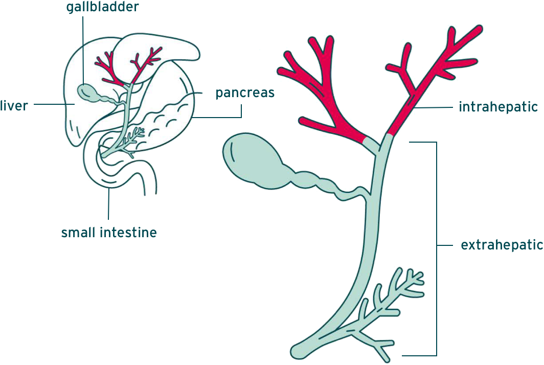 Bile Duct Cancer Types Intrahepatic And Extrahepatic